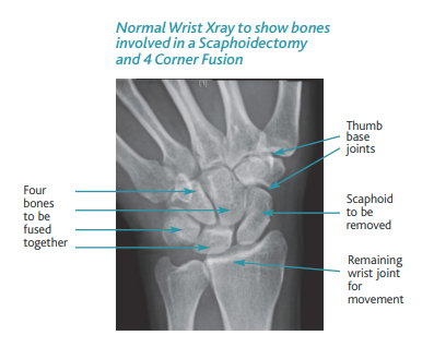 Partial and Total Wrist Fusion | Dubai Orthopedic Clinic