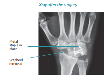 Partial and Total Wrist Fusion | Dubai Orthopedic Clinic