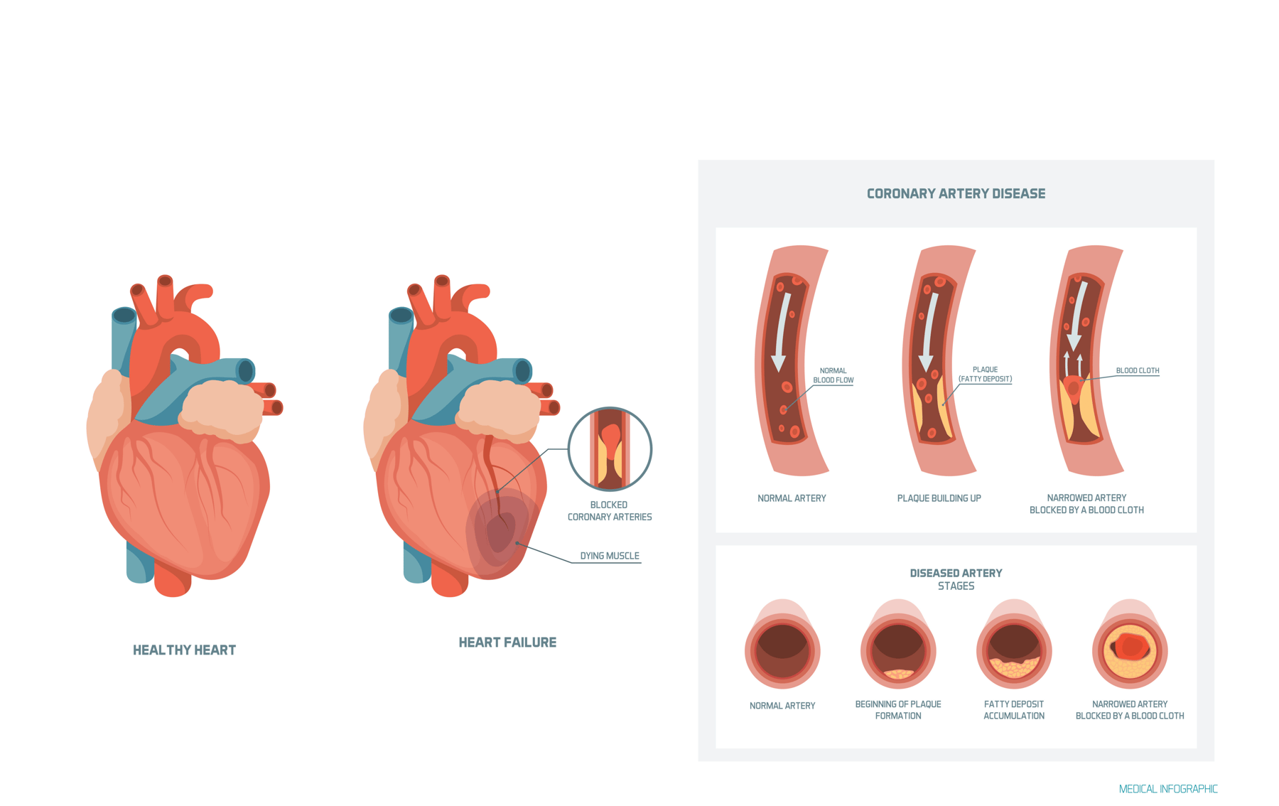 Coronary Artery Disease (CAD) | DRHC Dubai Cardiology Clinic