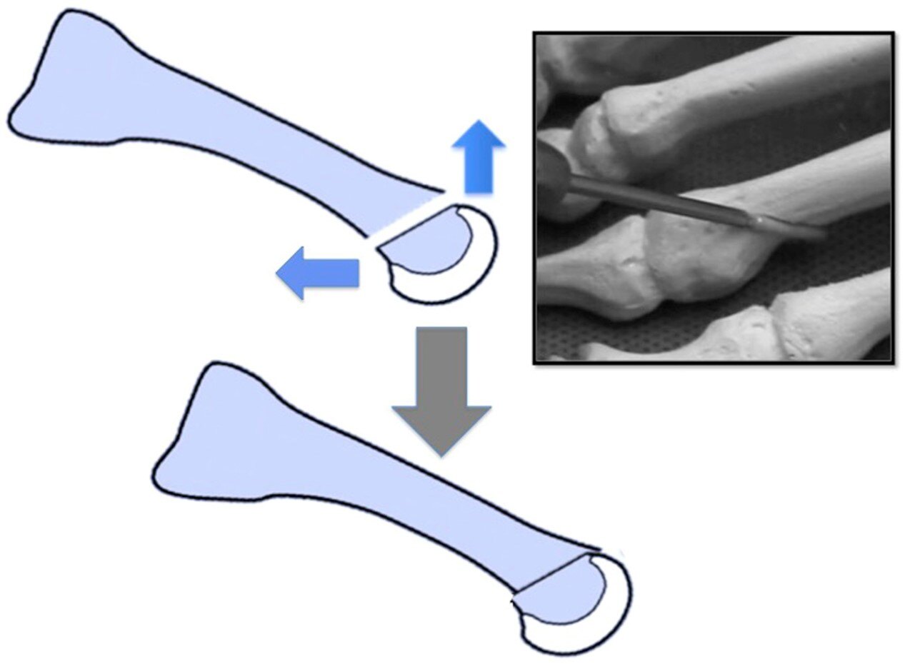 Distal Metaphyseal Metatarsal Osteotomy (DMMO) | Dubai foot & Ankle Clinic