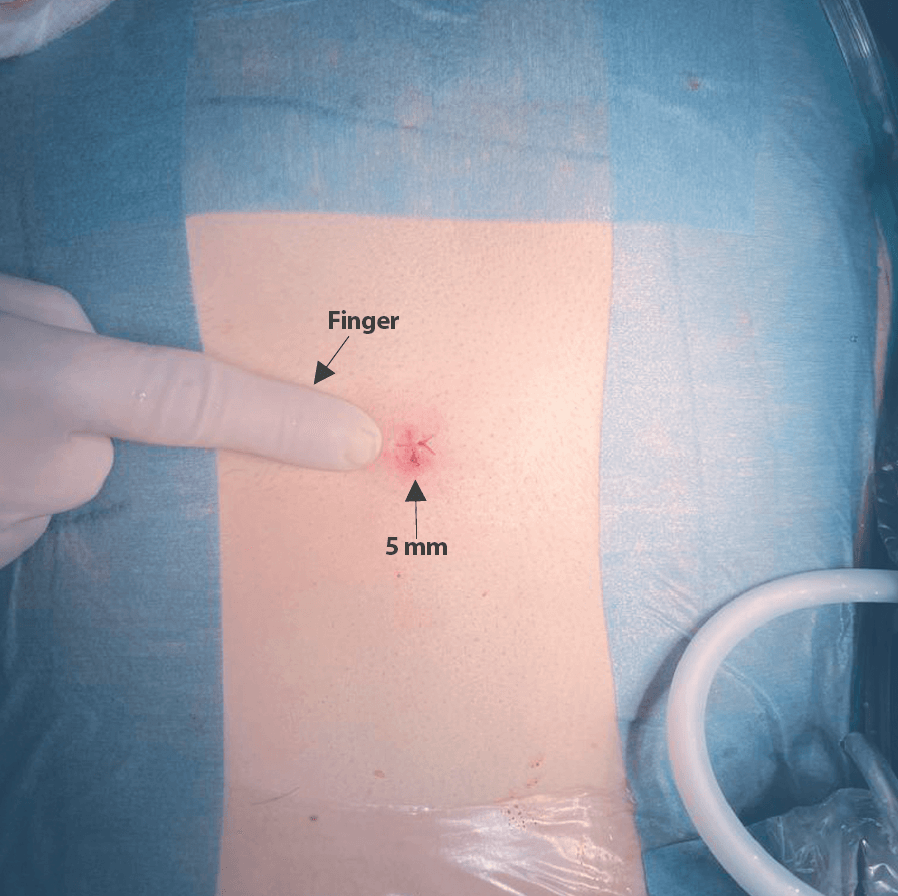 Full Endoscopic Spinal Discectomy - Spine Hospital Dubai DRHC