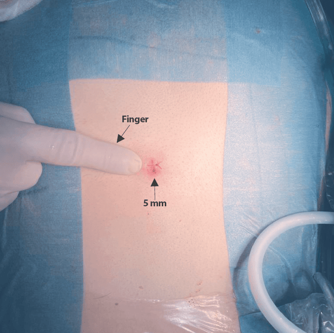 Full Endoscopic Spinal Discectomy - Spine Hospital Dubai DRHC