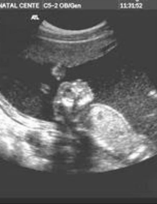 Fetal Anomaly Scan | Dubai Gynaecology Clinic