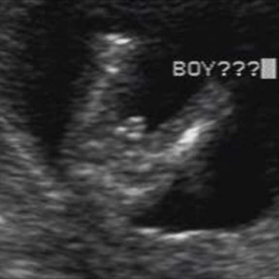 Fetal Anomaly Scan | Dubai Gynaecology Clinic