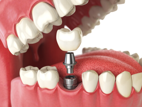 Cost of dental implant packages | Dental Clinic in Dubai