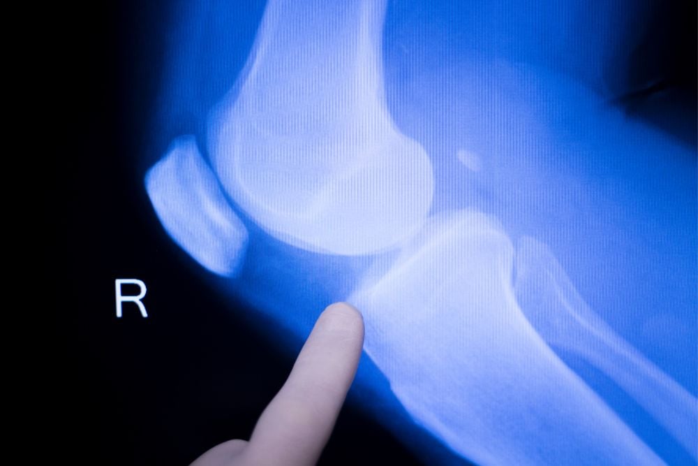 تمزق الغضروف المفصلي | عيادة دبي لجراحة العظام