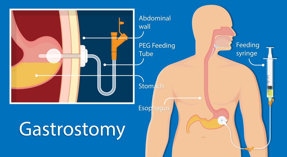 Peg Dubai Gastroenterology Clinic