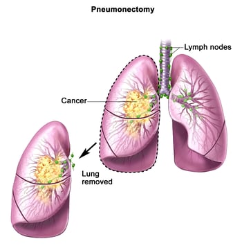 Pneumonectomy Surgery | Advanced Thoracic Procedures at DRHC Dubai
