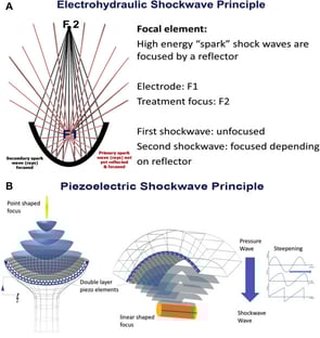 Principle of Shockwave Generations | DRHC Dubai