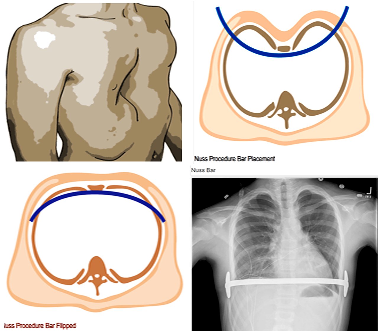 Chest wall deformities | Dr. Rami Hamed Center