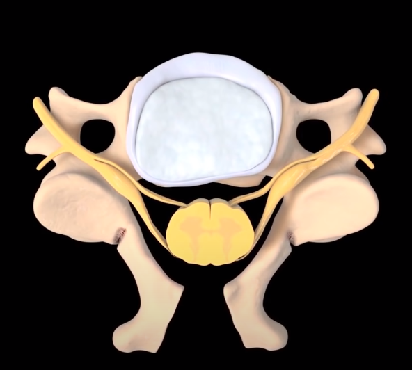 Spinal Decompression Surgery | Laminoplasty at DRHC Dubai