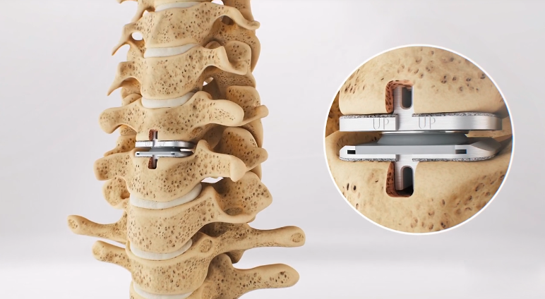 Artificial Disc Replacement | Advanced spine Procedure at DRHC Dubai