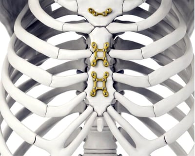 Sternal Fixation Surgery | Dubai Thoracic Surgery Clinic