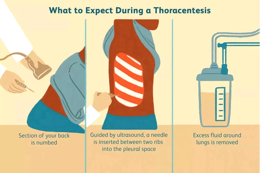 Thoracic surgery | Dr. Rami Hamed Center/Thoracentesis
