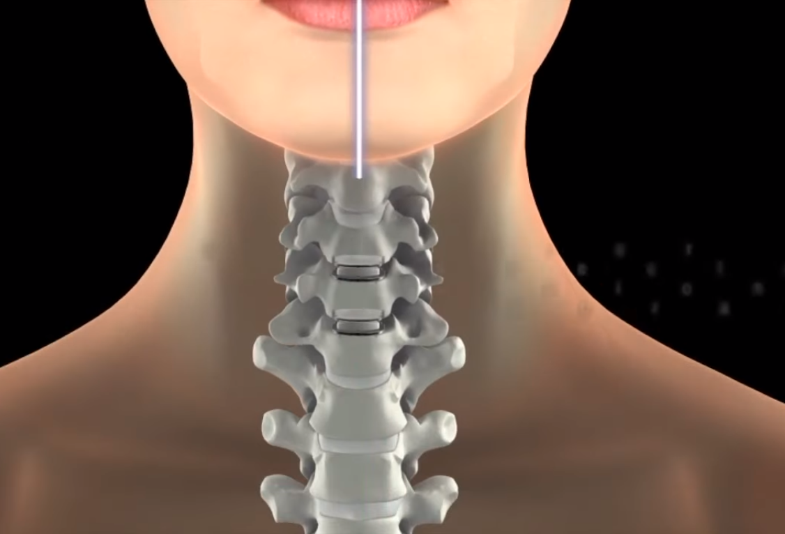 Cervical Disc Replacement Surgery | DRHC Dubai Spine Hospital