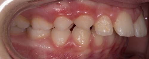 Treatment of class 2 division 2 malocclusion | Orthodontist clinic