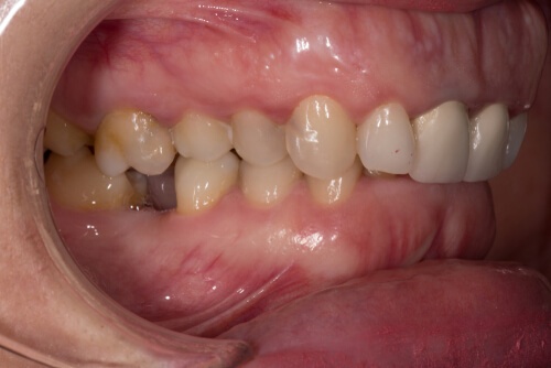 Treatment of class 2 division 2 malocclusion | Orthodontist clinic