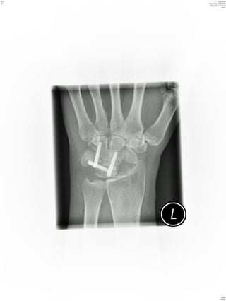 Partial and Total Wrist Fusion | Dubai Orthopedic Clinic