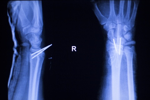 Wrist Replacement Surgery | Dubai Orthopedic Clinic