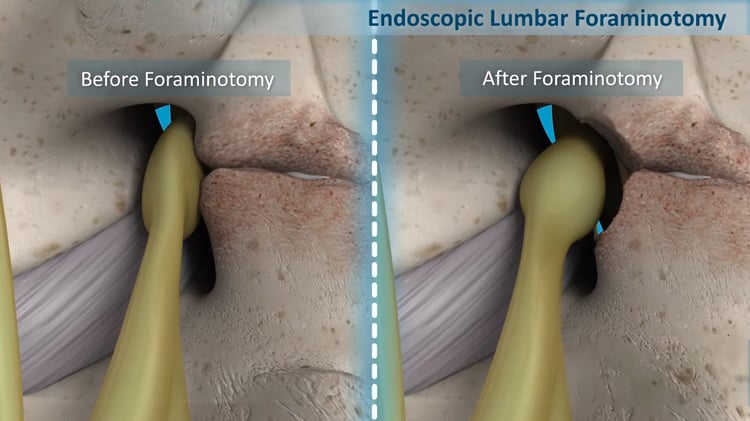 Spinal Decompression Surgery | Foraminotomy at DRHC Dubai