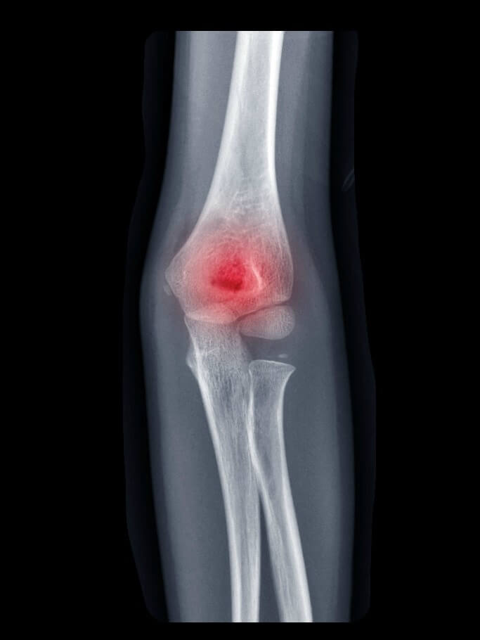 Pediatric Supracondylar Fracture Drhc Dubai Pediatric Orthopedic