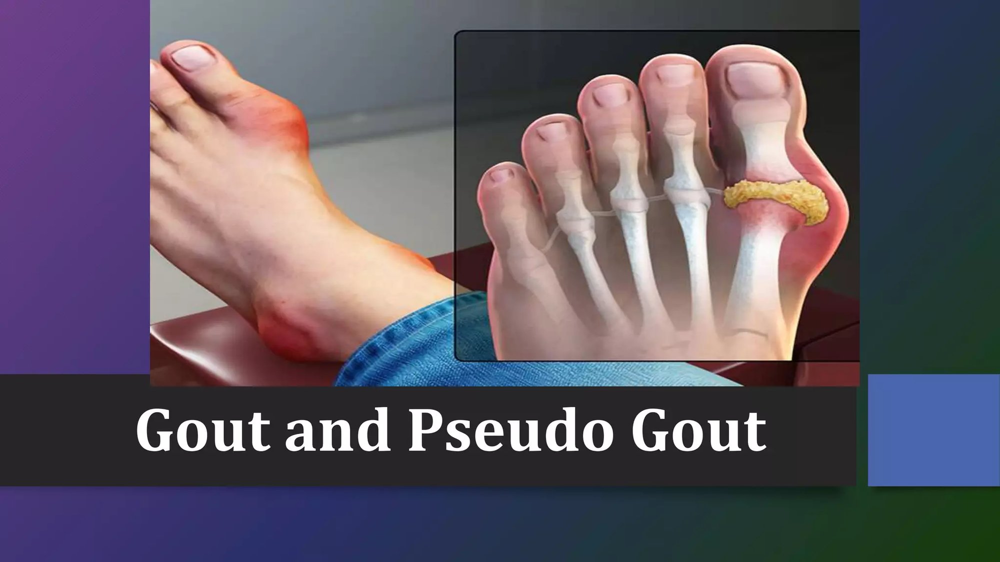 Gout and Pseudo-Gout Treatment | Rheumatology DRHC Dubai