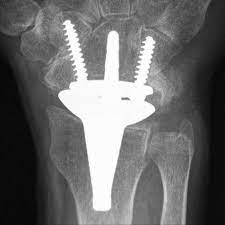 Partial and Total Wrist Replacement | Dubai Orthopedic Clinic