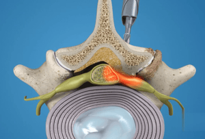 Spinal Decompression Surgery | Laminectomy at DRHC Dubai