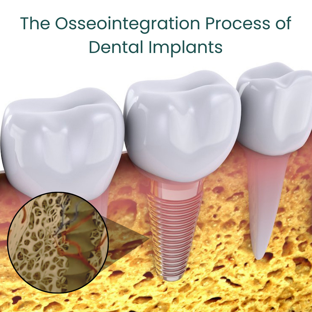 Osseointegration of Implants | Laser Treatment | Dental Clinic Dubai