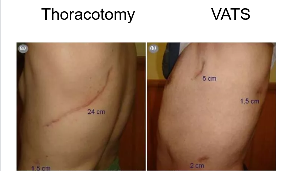 Video-Assisted Thoracic Surgery (VATS) Dubai | DRHC Thoracic Surgery