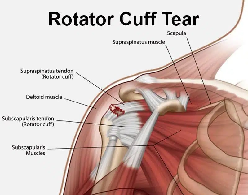 Rotator Cuff Tear Drhc Dubai Shoulder Clinic
