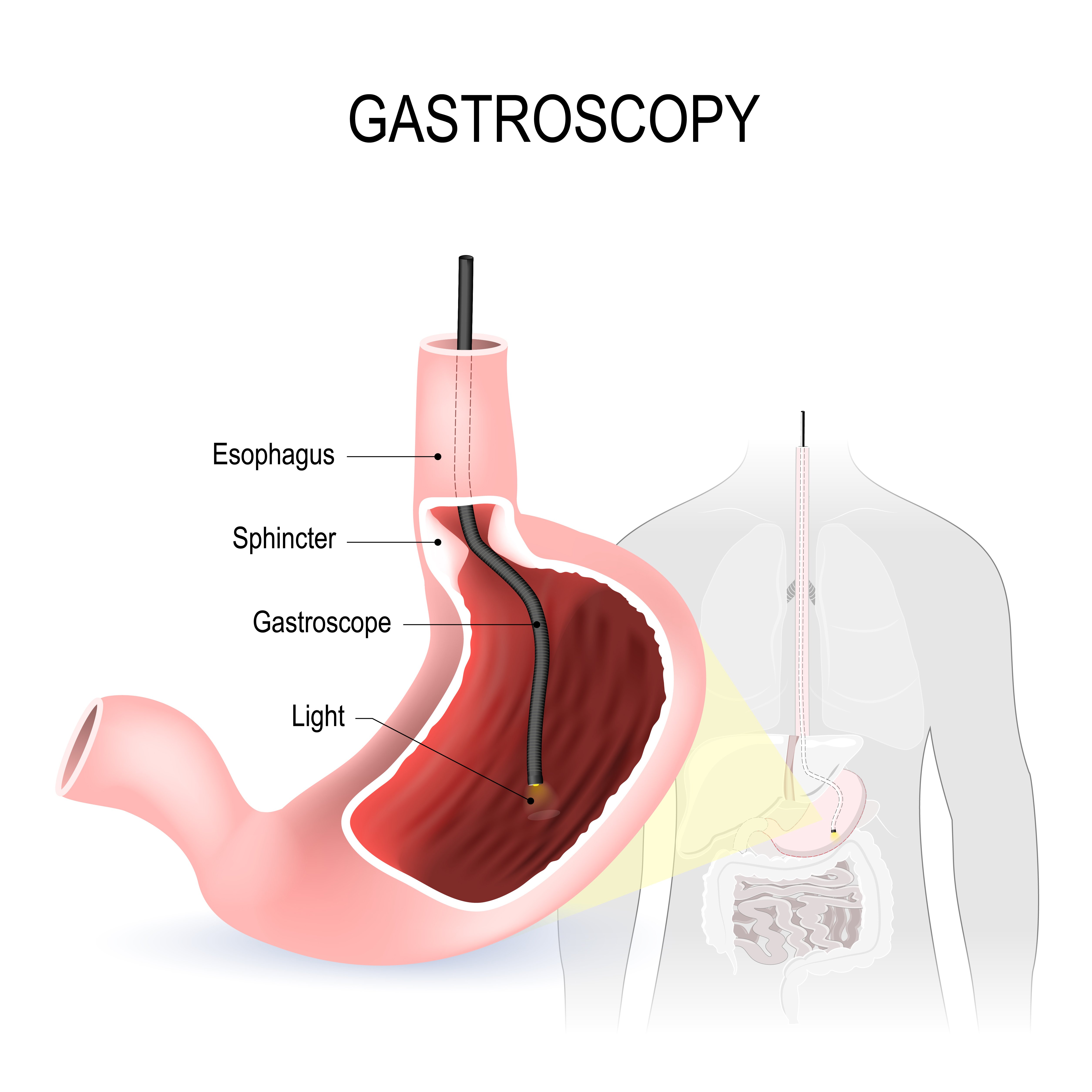 Gastroscopy | Dubai Gastroenterology Clinic