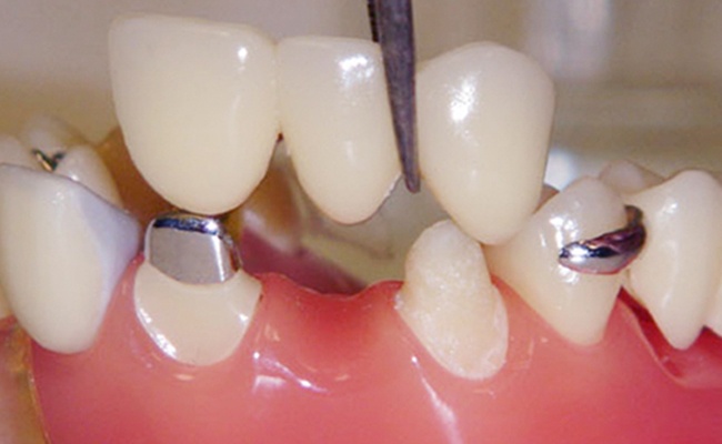 Dental Clinic in Dubai | Prosthodontist | Dental Bridge