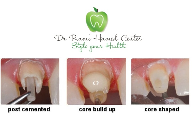 Dental Clinic in Dubai | Prosthodontist | Post and Core