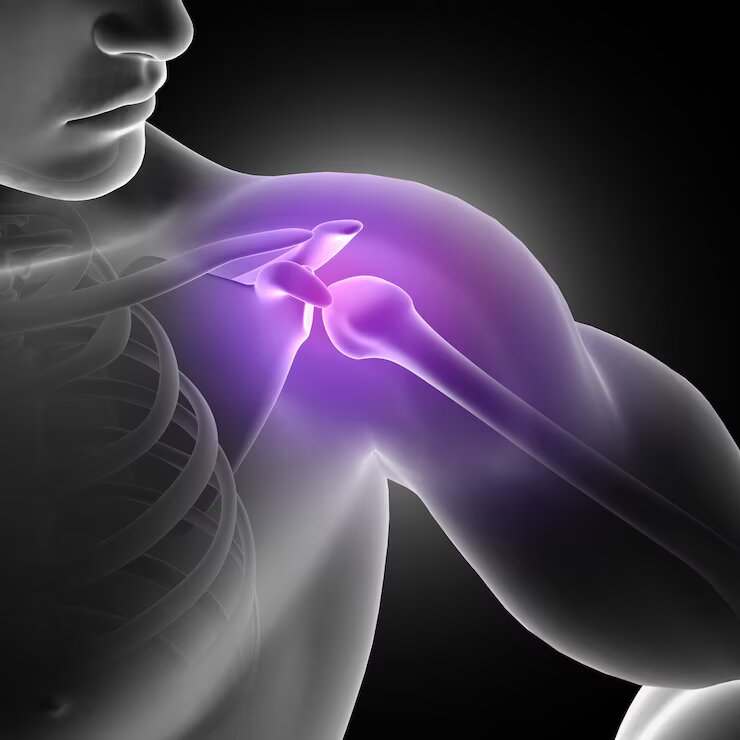 Calcifying tendinitis of the shoulder | DRHC Dubai Physiotherapy
