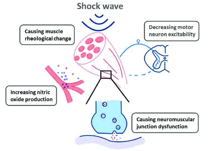 Mechanism of Shockwave Therapy | DHRC Dubai
