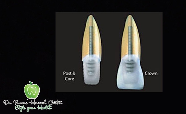 Dental Clinic in Dubai | Prosthodontist | Post and Core