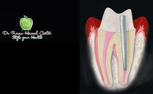 Dental Clinic in Dubai | Prosthodontist | Post and Core