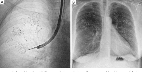 Best endobronchial coil clinic in dubai |Dr. Rami Hamed Center