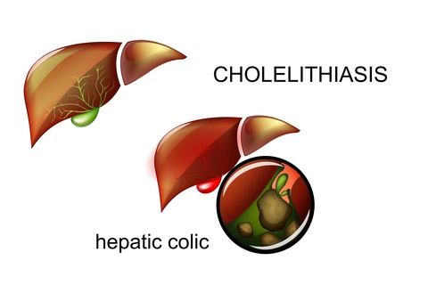 Cholelithiasis | Dubai General Surgery Clinic | Dr. Rami Hamed Center